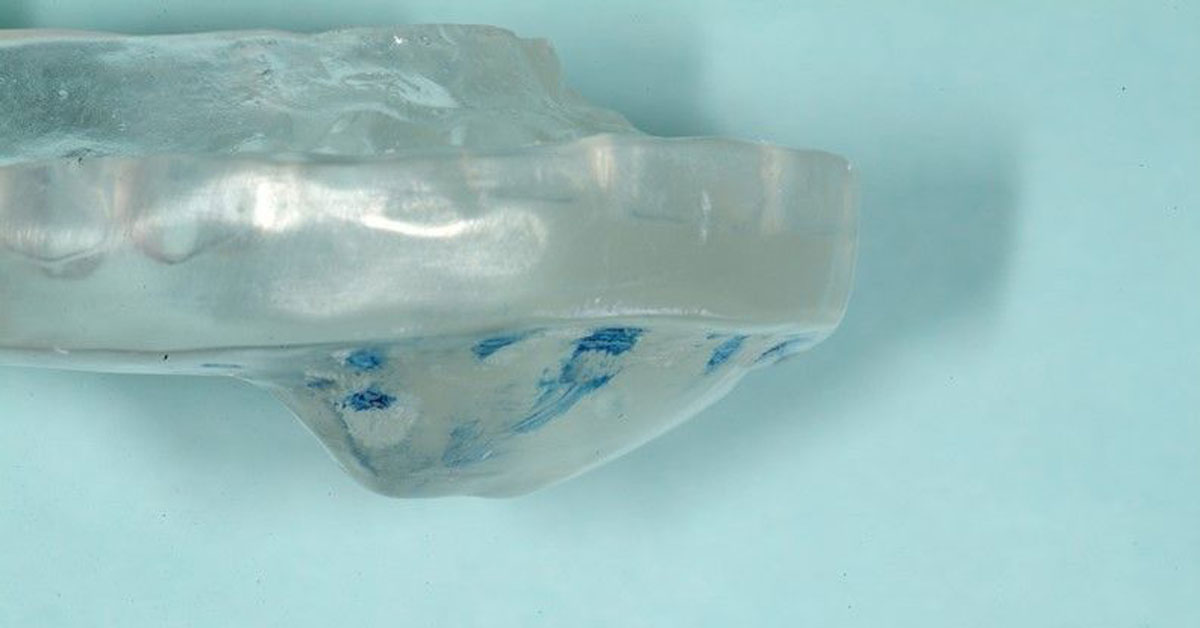 Anterior Repositioning Appliance: The Night Guard You Never Heard Of ...