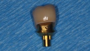 Implant Crowns: Cement, Screw or Both? - Spear Education