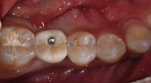 Implant Crowns: Cement, Screw or Both? - Spear Education