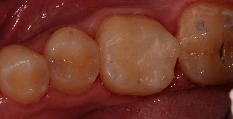Pulp Capping: Can We and Should We? - Spear Education