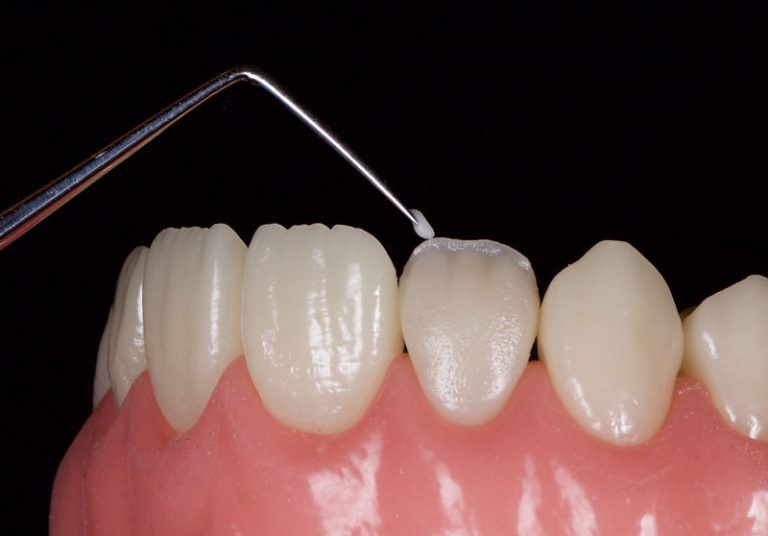 Restoration of the Peg Lateral: The Direct Resin Approach - Spear Education