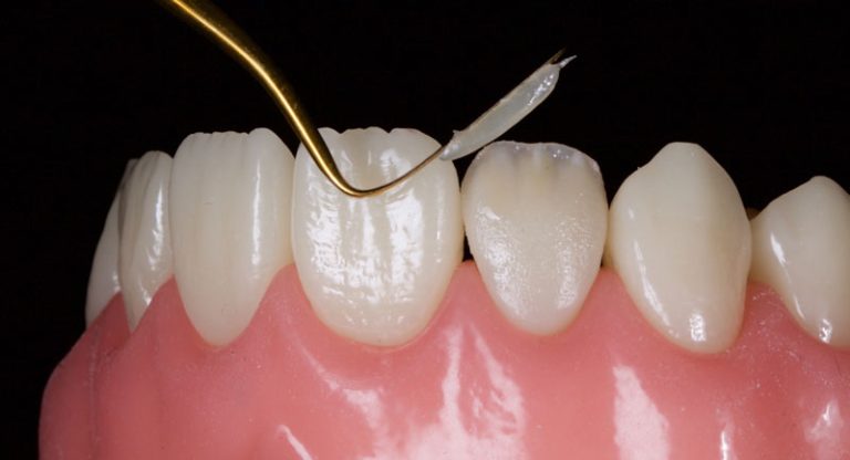 Restoration of the Peg Lateral: The Direct Resin Approach - Spear Education