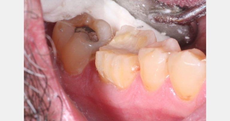 10 Steps to Posterior Crown Prep - Spear Education