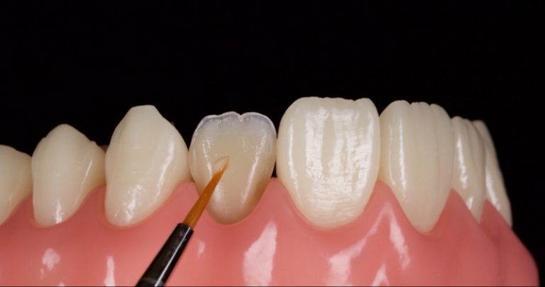 Advantages of Direct Composite Resin Veneers When Masking Tooth ...