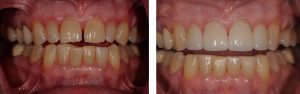 Enamel Rods: The Key to Successful Restorative Adhesion - Spear Education
