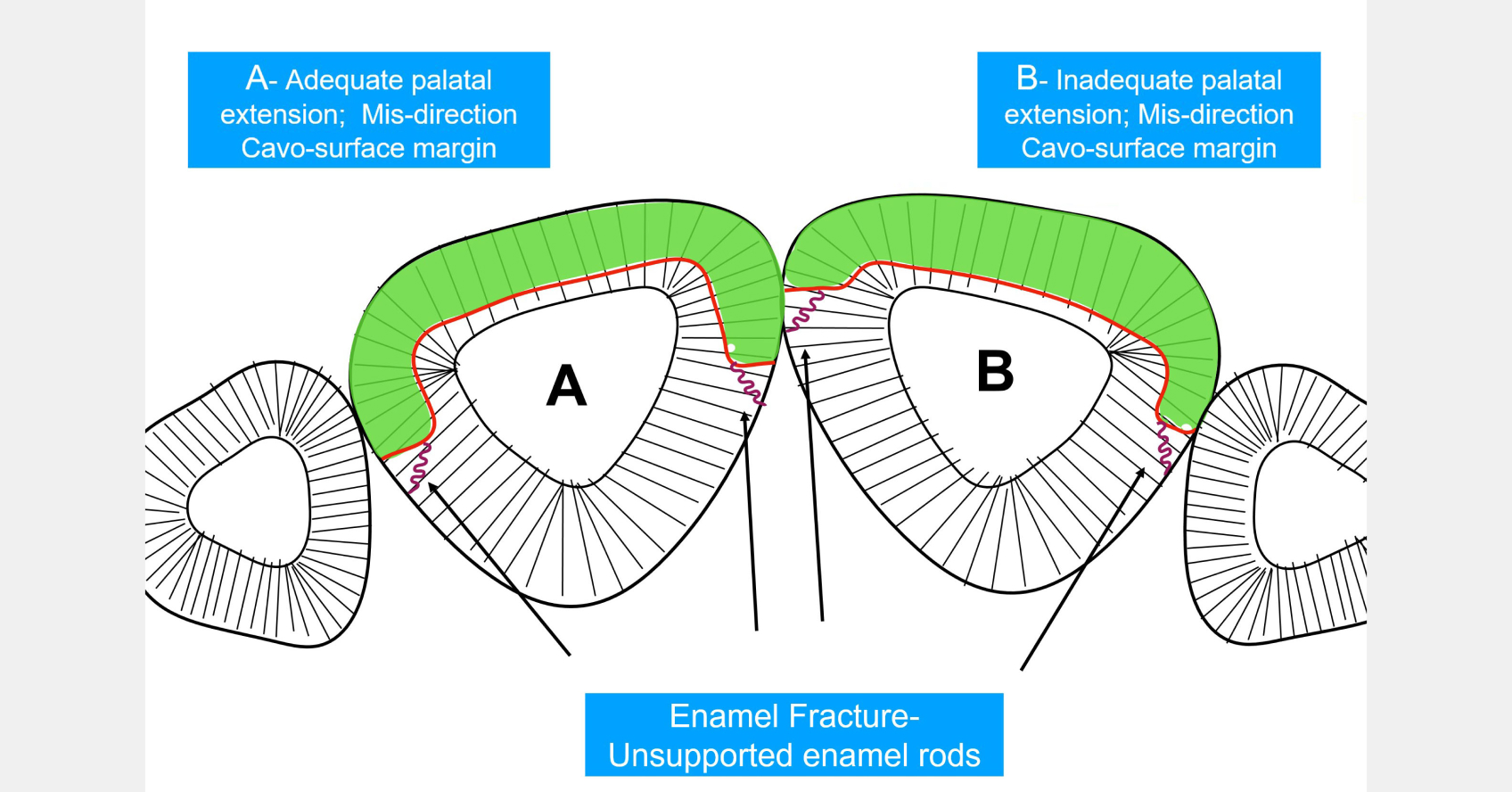 Enamel Rods: The Key to Successful Restorative Adhesion - Spear Education