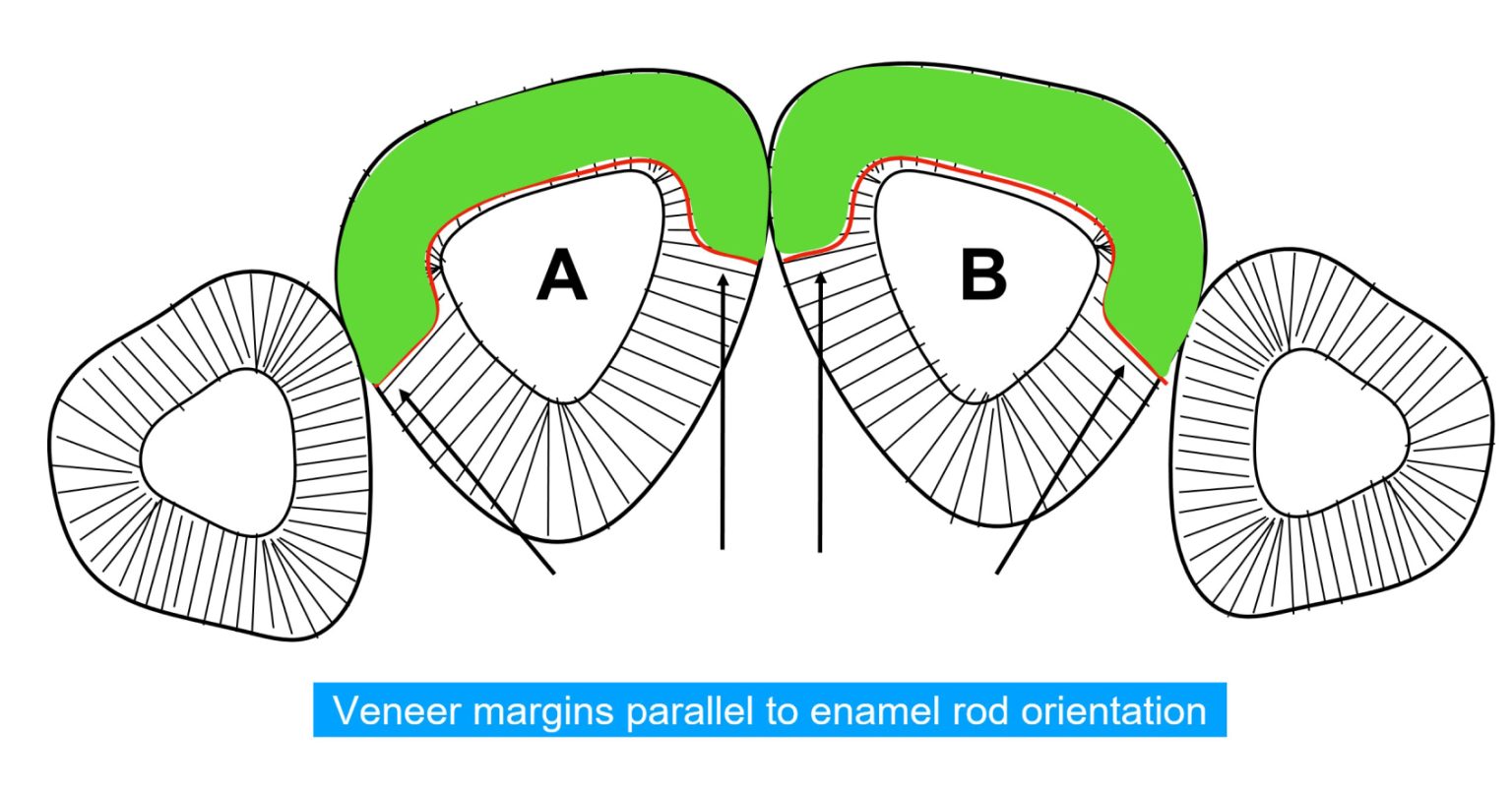 Enamel Rods: The Key to Successful Restorative Adhesion - Spear Education