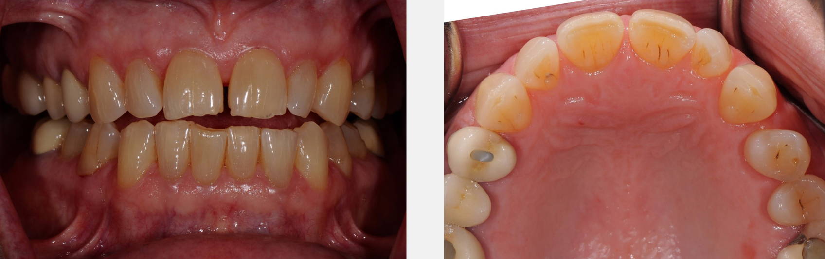 Enamel Rods: The Key to Successful Restorative Adhesion - Spear Education