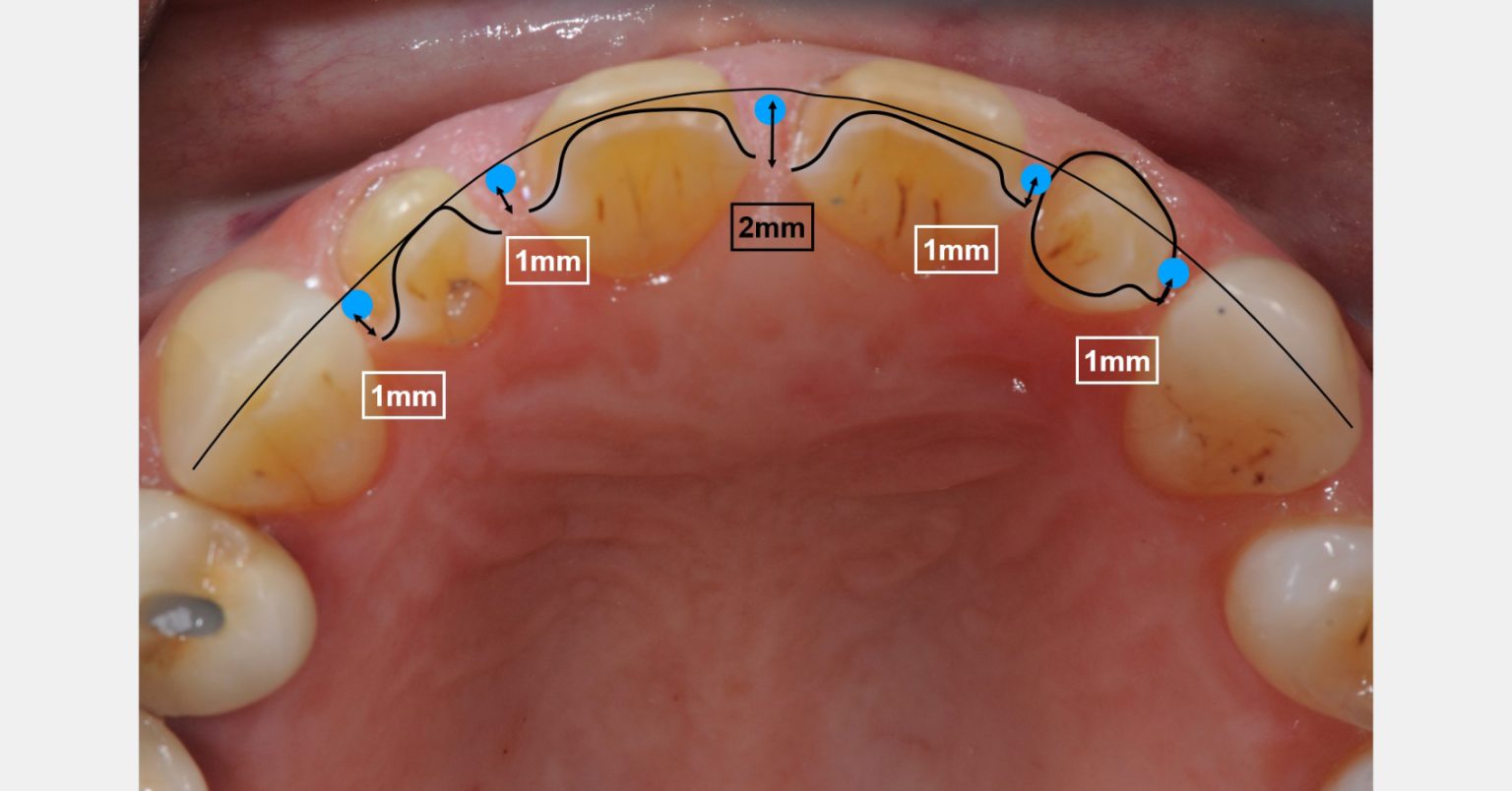 Enamel Rods: The Key to Successful Restorative Adhesion - Spear Education