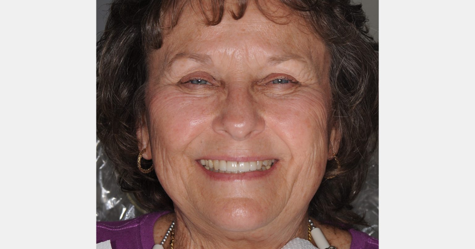 Enamel Rods: The Key to Successful Restorative Adhesion - Spear Education