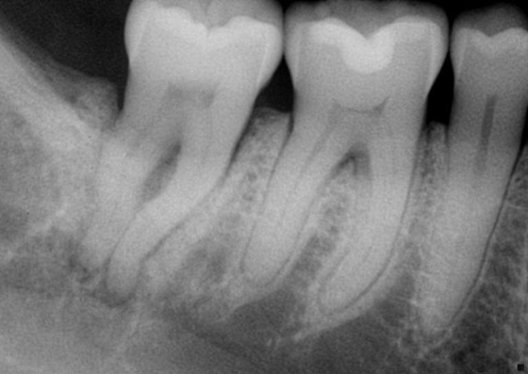 Vertical Root Fractures: The Diagnostic Dilemma and Hidden Menace ...