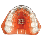 A Comparison of Orthodontic Retention Options - Spear Education