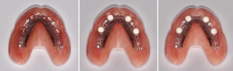 Novaloc Overdenture System: A New Approach To Low-Profile Attachments ...