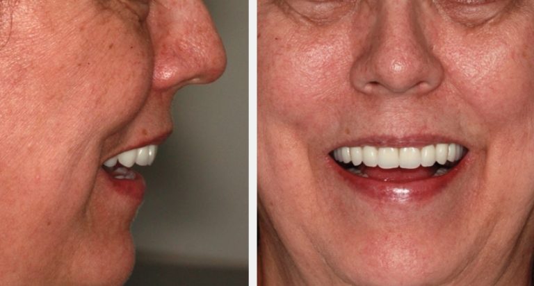 Novaloc Overdenture System: A New Approach To Low-Profile Attachments ...