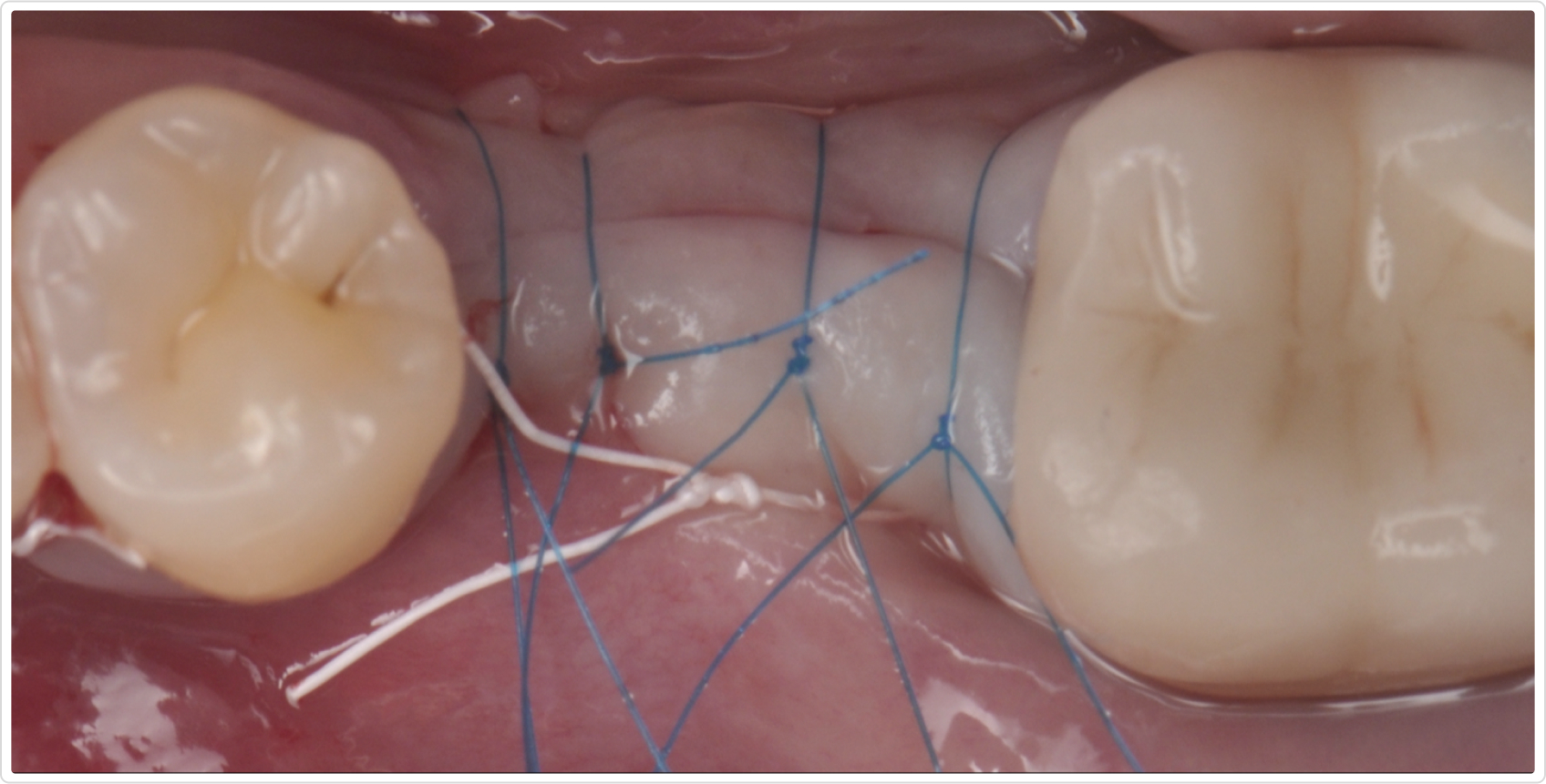 Comprehensive Alveolar Ridge Augmentation and Implant Placement: A Case ...