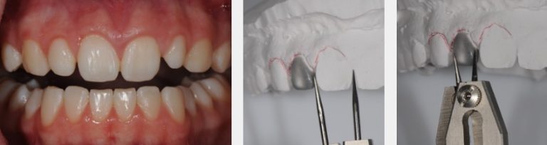 Using Golden Percentage in Dentistry for Ideal Tooth Proportions ...