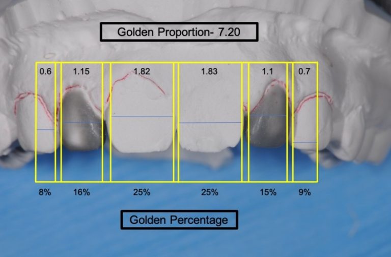 Using Golden Percentage in Dentistry for Ideal Tooth Proportions ...