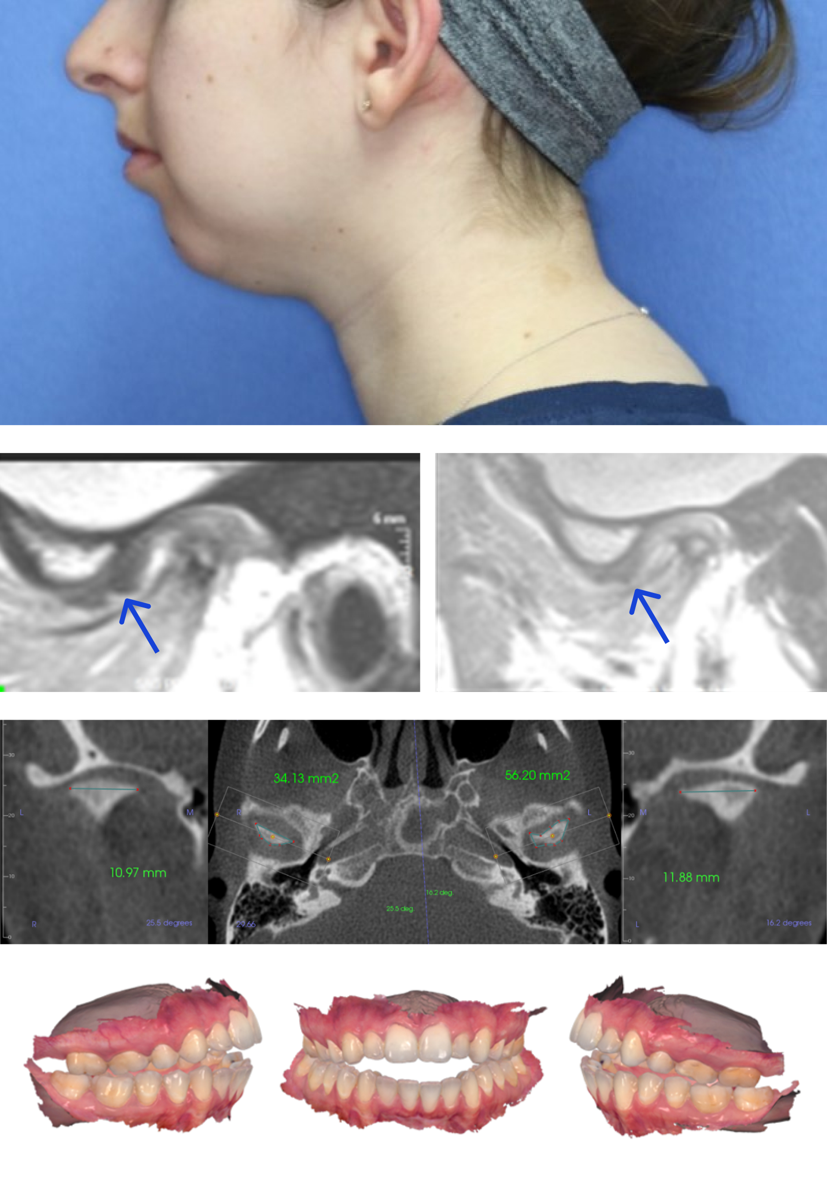 Idiopathic Condylar Resorption: Reality or Myth? - Spear Education