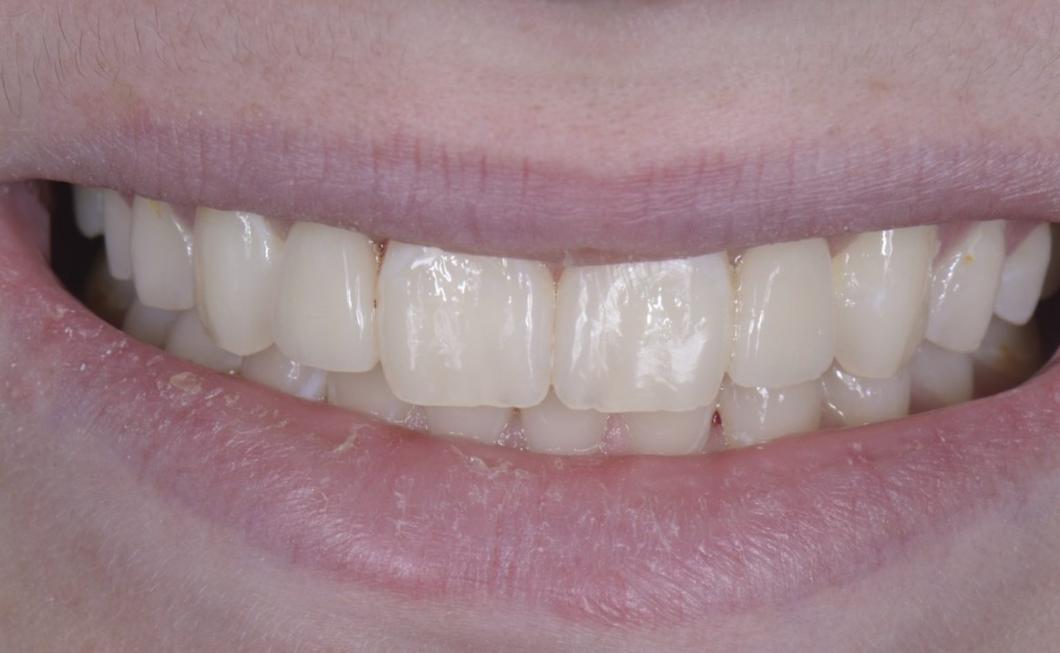 Three Solutions for Congenitally Missing Lateral Incisors: A Photo ...