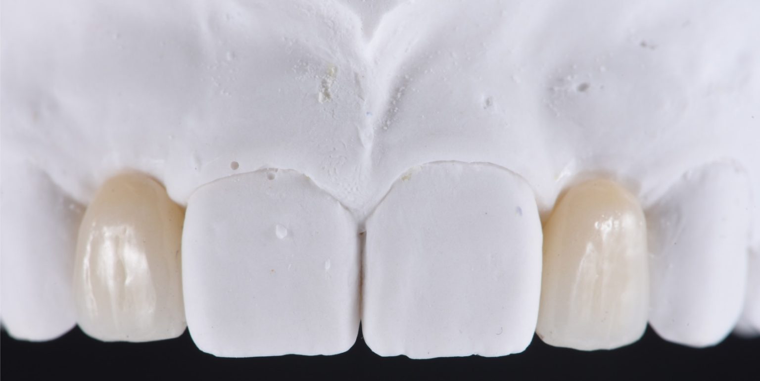 Three Solutions for Congenitally Missing Lateral Incisors: A Photo ...