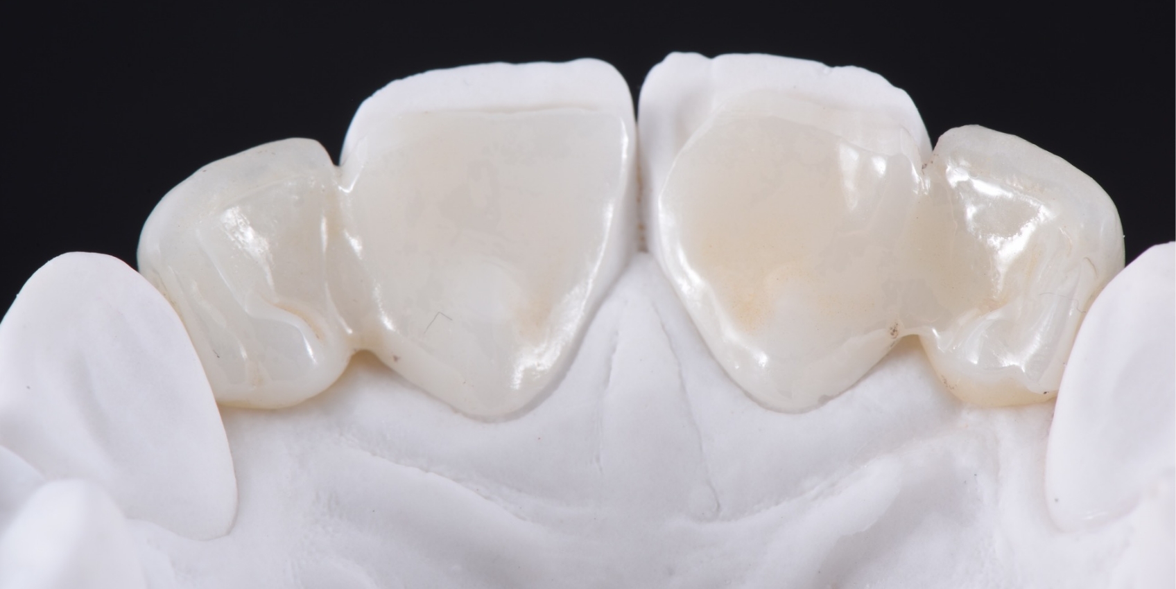 Three Solutions for Congenitally Missing Lateral Incisors: A Photo ...