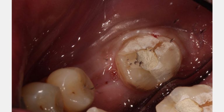 Restoration With the Endocrown - Spear Education