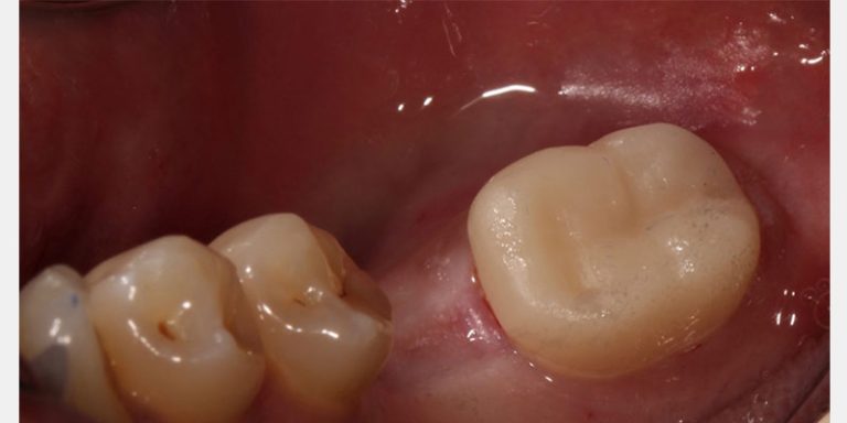 Restoration With the Endocrown - Spear Education