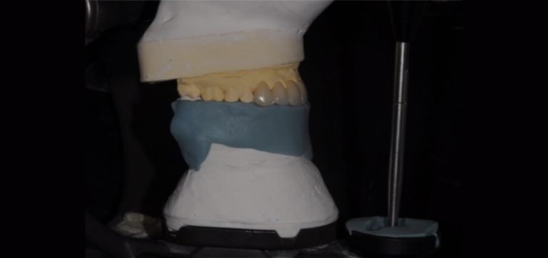 The Importance and Strategy Behind Custom Incisal Guide Tables - Spear ...