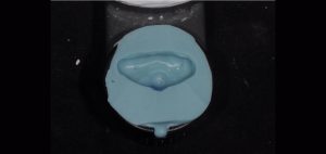 The Importance and Strategy Behind Custom Incisal Guide Tables - Spear ...