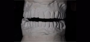 The Importance and Strategy Behind Custom Incisal Guide Tables - Spear ...