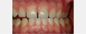 The Importance and Strategy Behind Custom Incisal Guide Tables - Spear ...