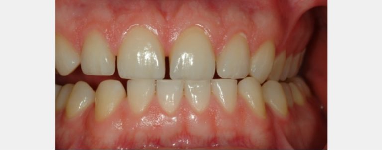 The Importance and Strategy Behind Custom Incisal Guide Tables - Spear ...