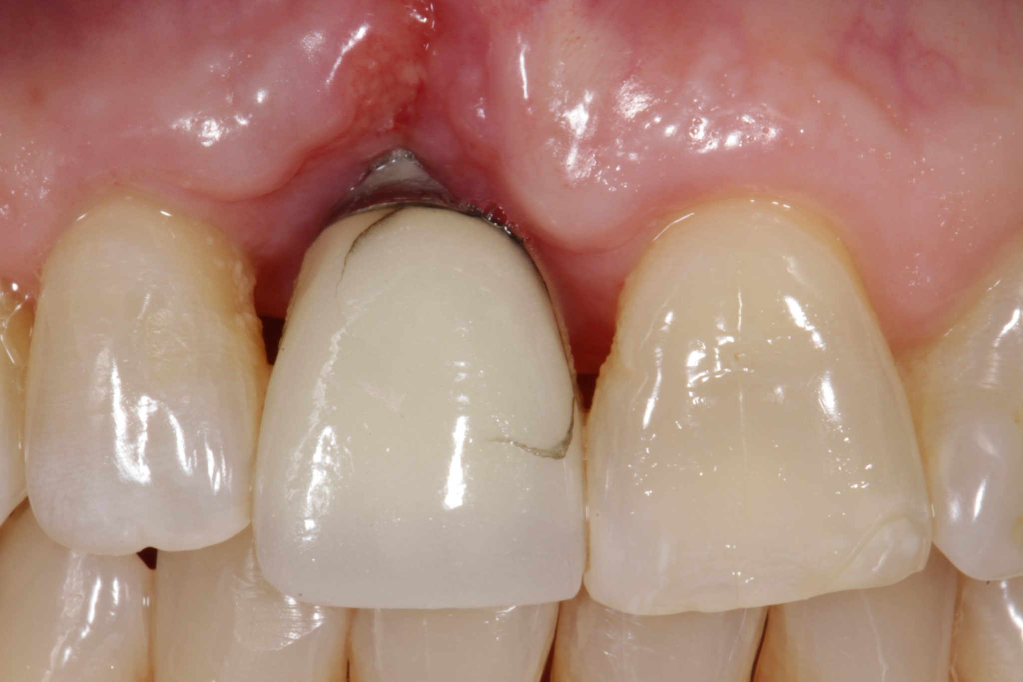 Loading Protocols for Dental Implants - Spear Education