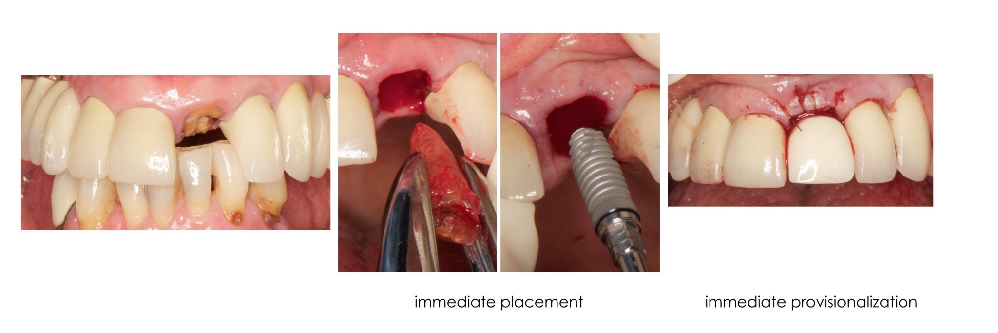 Loading Protocols for Dental Implants - Spear Education