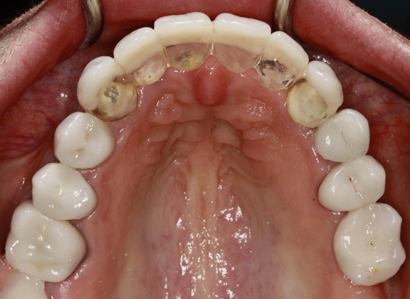 Tooth Supported Fixed Bridge for Missing Maxillary Incisors - Spear ...