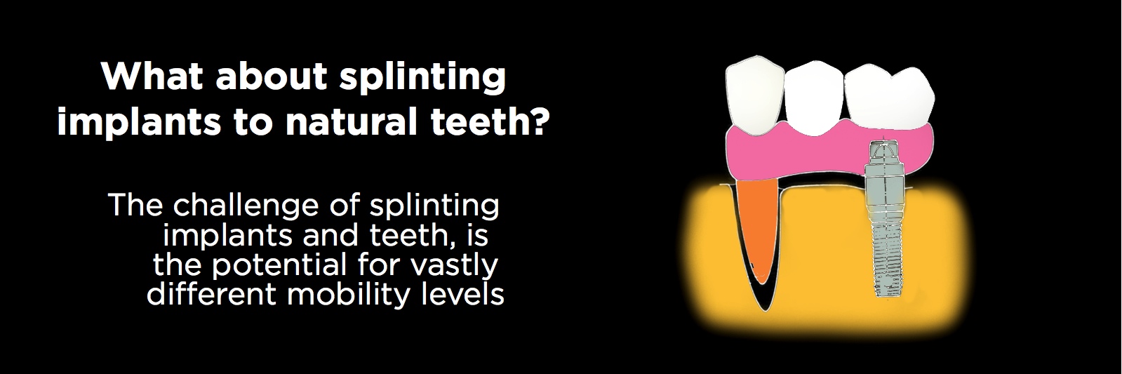 Connecting Teeth and Implants: Yes, No, Maybe? - Spear Education