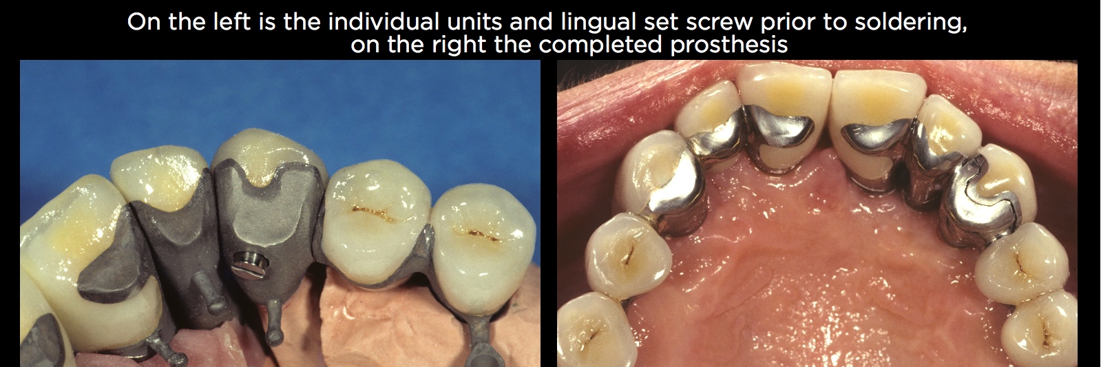 Connecting Teeth and Implants: Yes, No, Maybe? - Spear Education