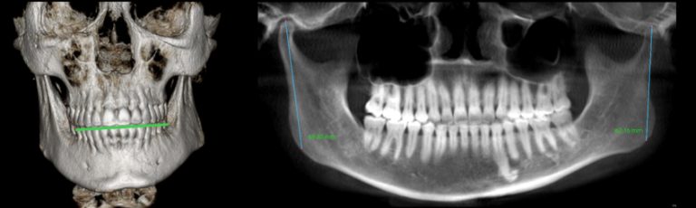 Temporomandibular Joint Space and Articular Disk Position: Is There a ...